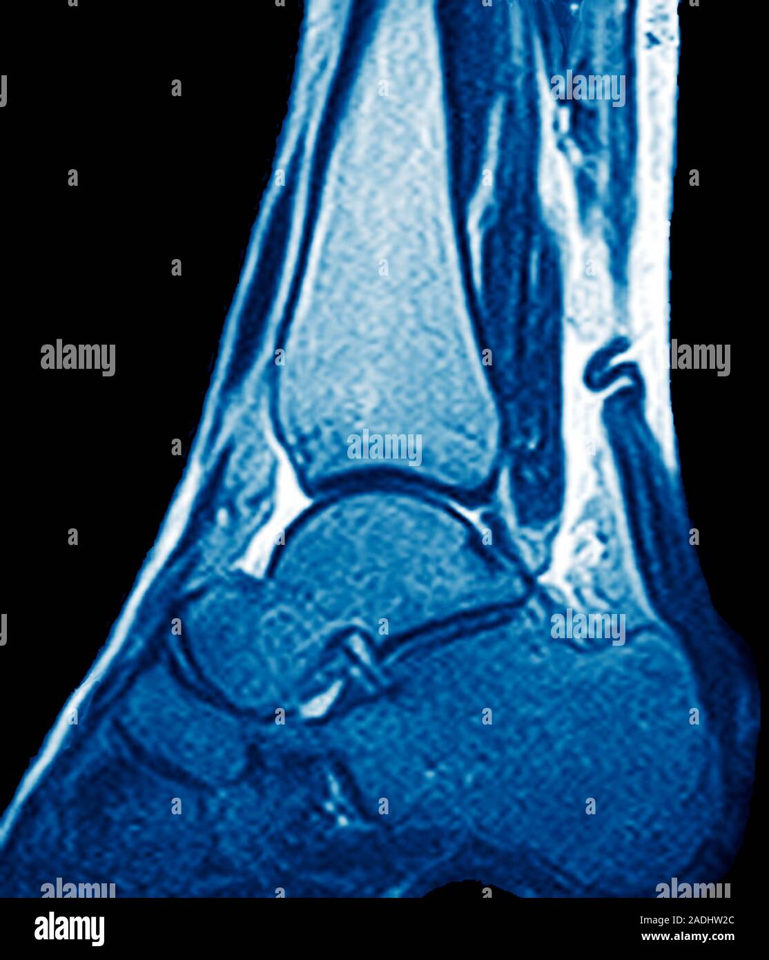 Ruptured Achilles tendon. Sagittal (side view) magnetic resonance ...