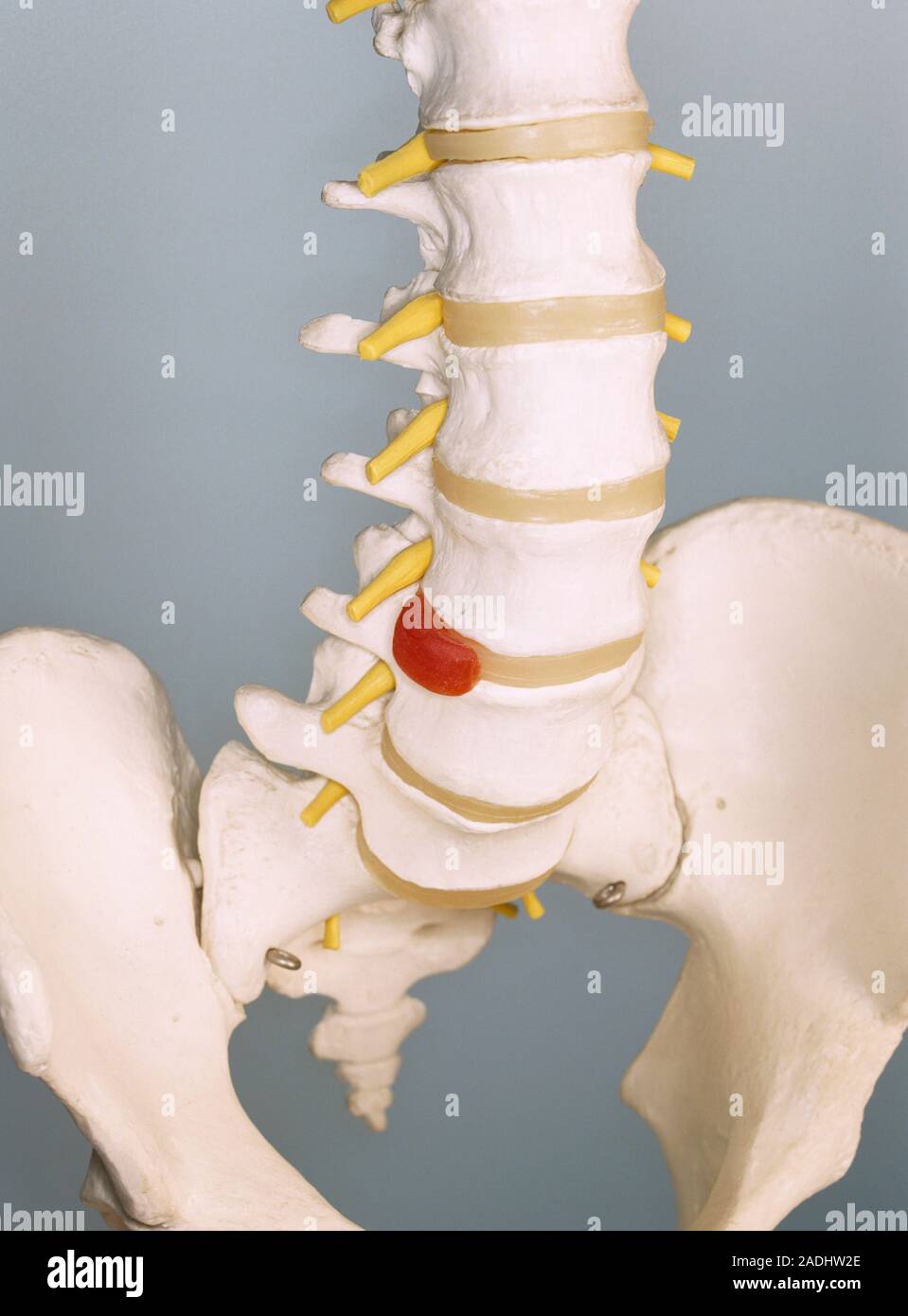 Slipped disc. Spinal model demonstrating a slipped intervertebral disc ...