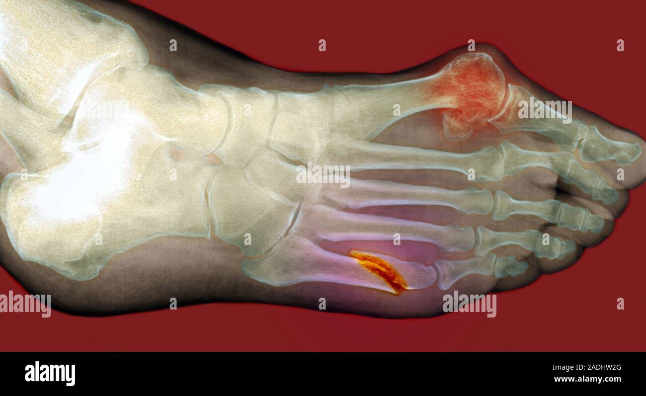 Fractured foot. Coloured X-ray of a spiral fracture (bottom, red) of ...