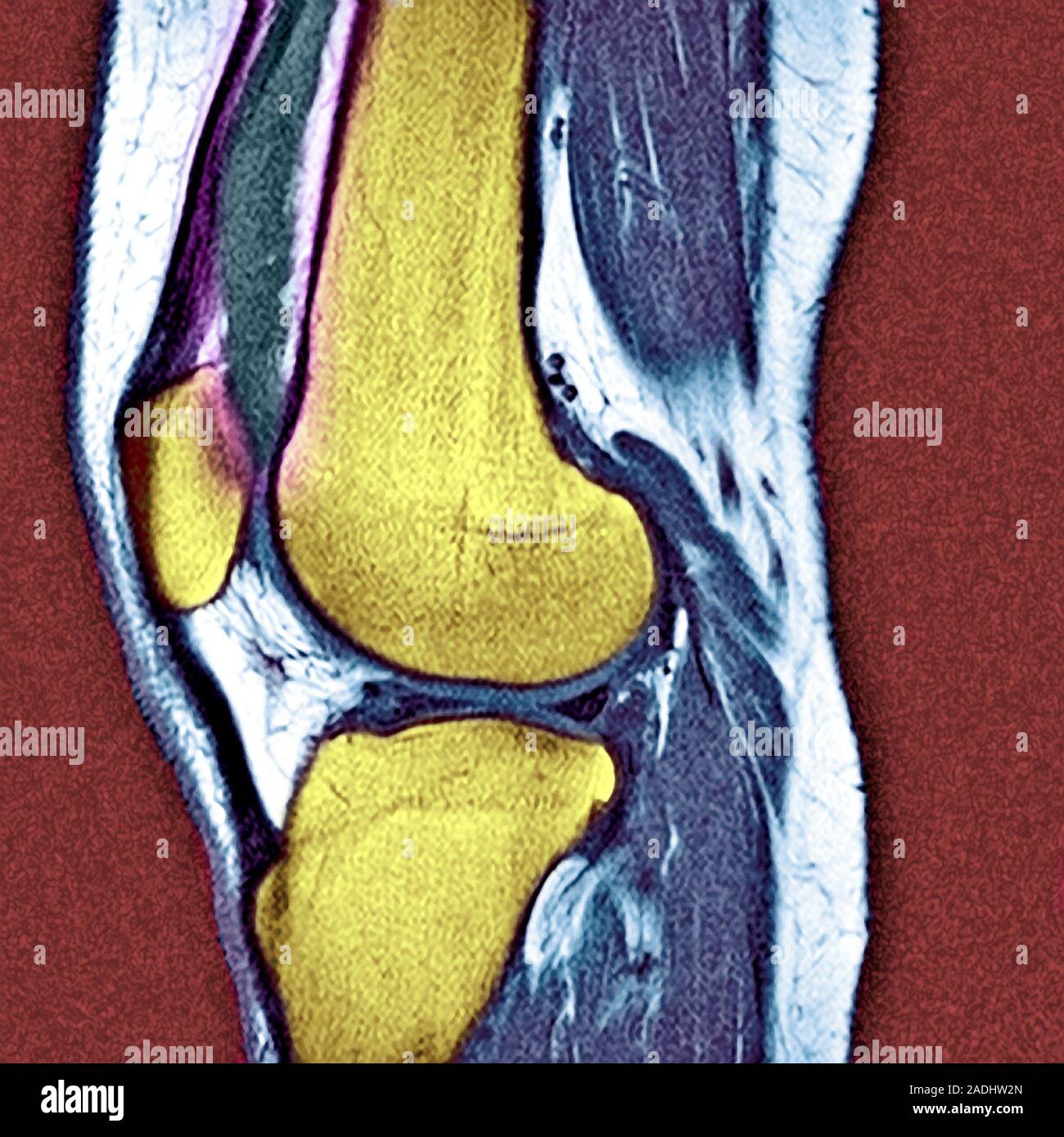 Knee effusion. Coloured X-ray of the swelling of an injured knee caused ...
