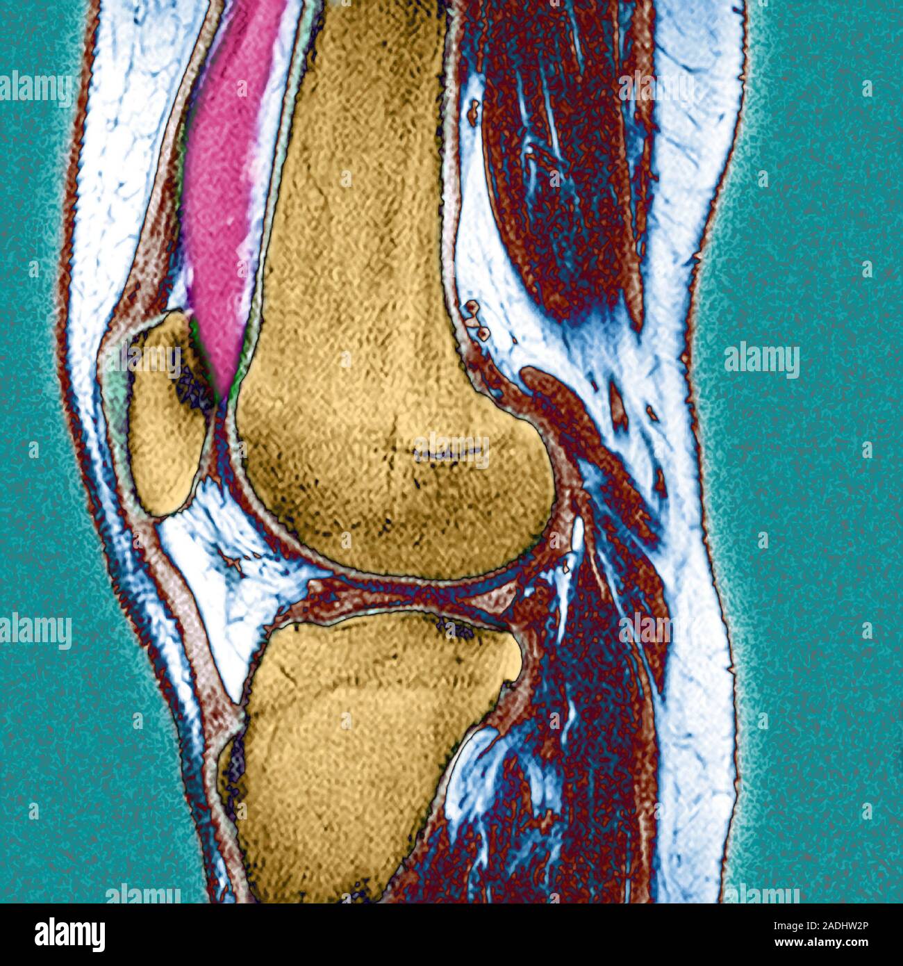 Knee effusion. Coloured X-ray of the swelling of an injured knee caused ...