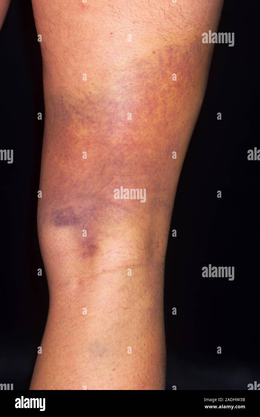 Bruise on the back of the thigh of a 42 year old woman caused by an ...