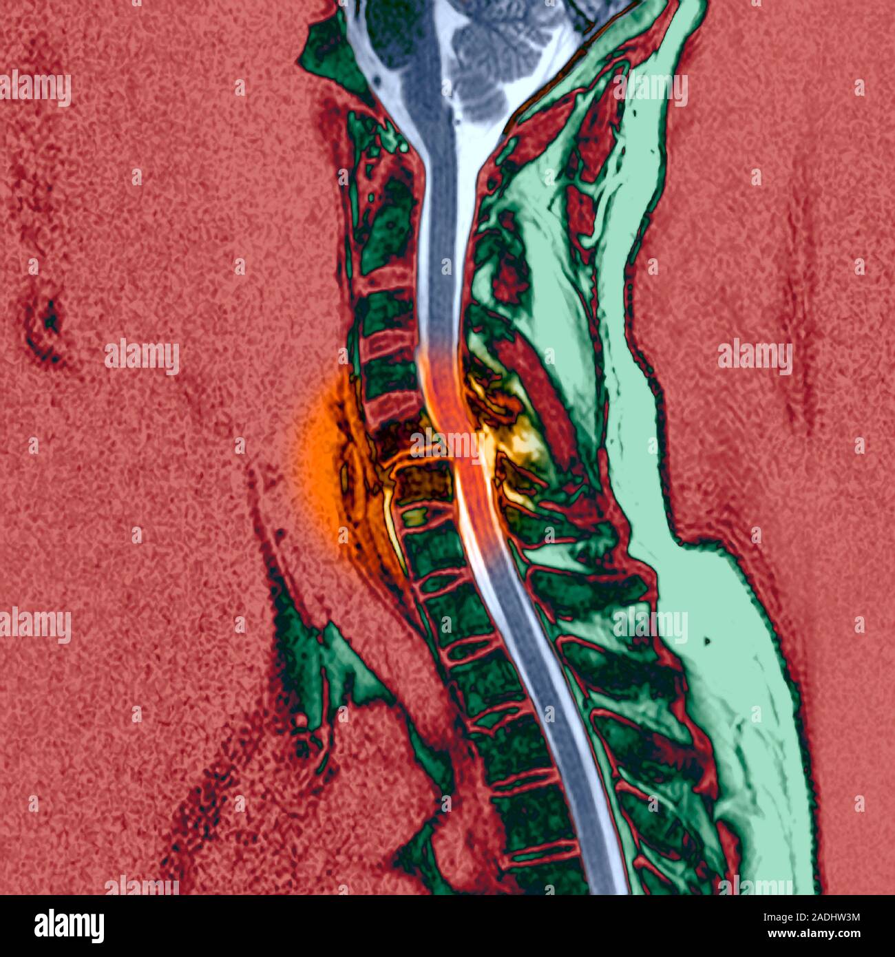 Broken neck. Coloured magnetic resonance imaging (MRI) scan of a ...