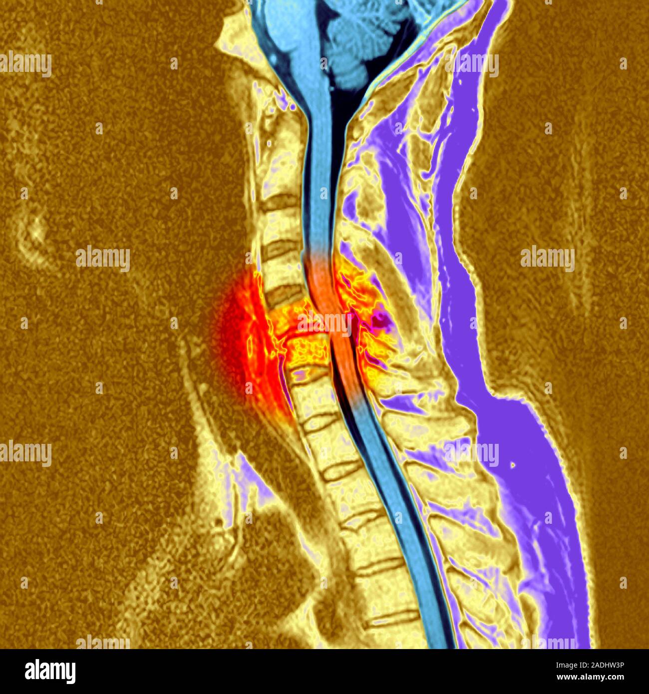 NEWCASTLE-UPON-TYNE/SCIENCE PHOTO LIBRARY Broken neck. Coloured ...