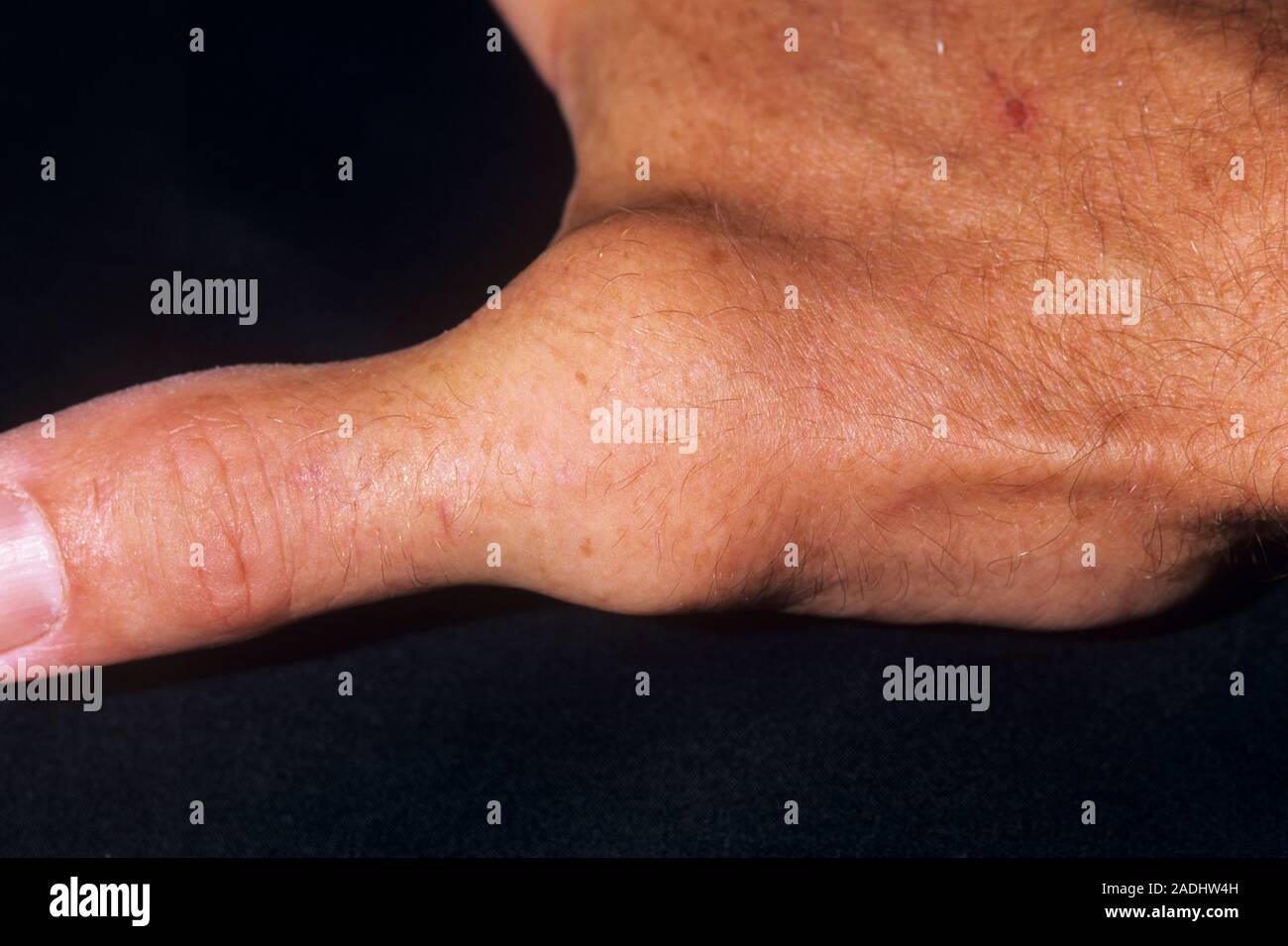 Swollen thumb. Swollen base of the thumb on the hand of a 46-year-old ...