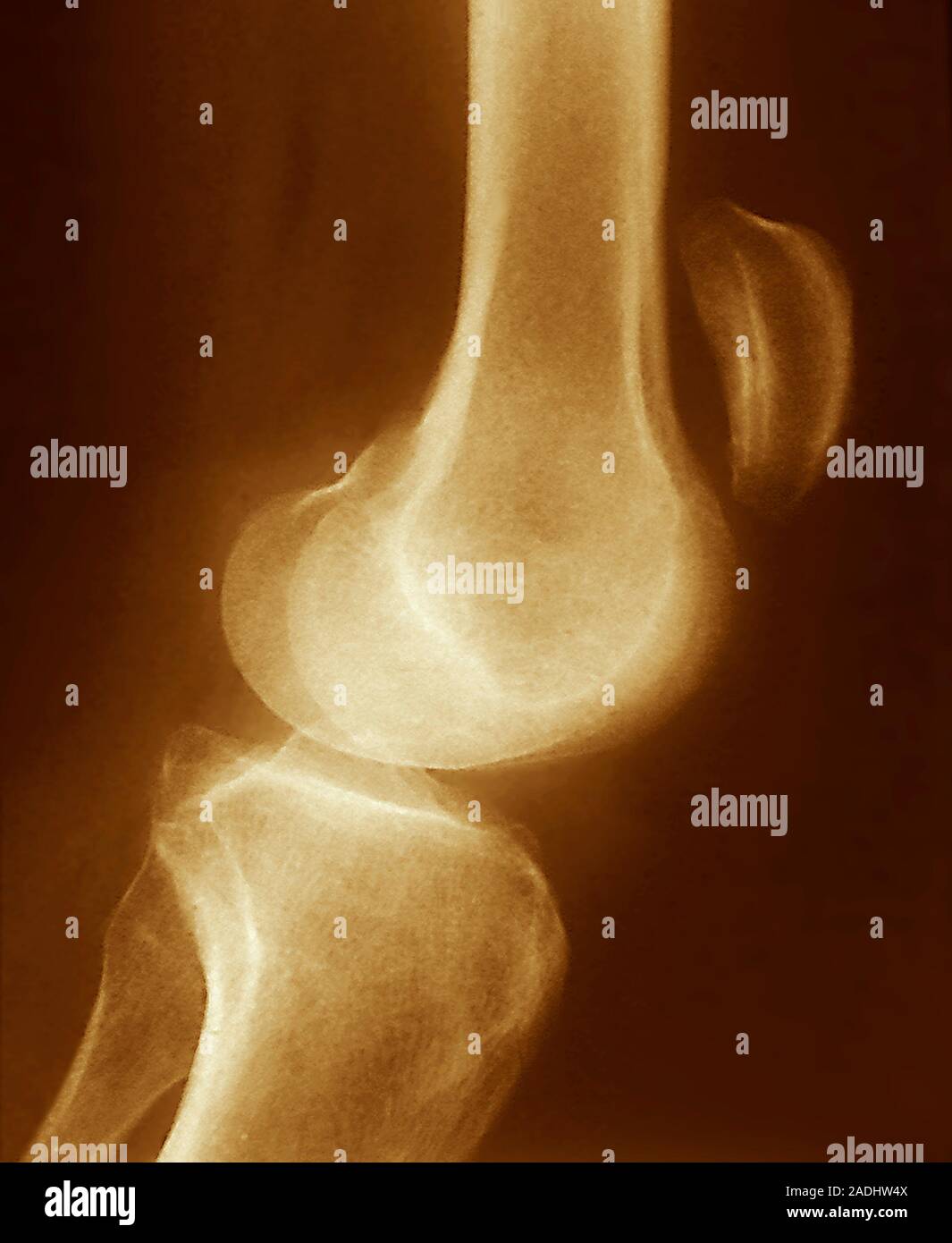 Dislocated kneecap. Coloured X-ray of a side-view of the leg of a patient with a dislocated ...