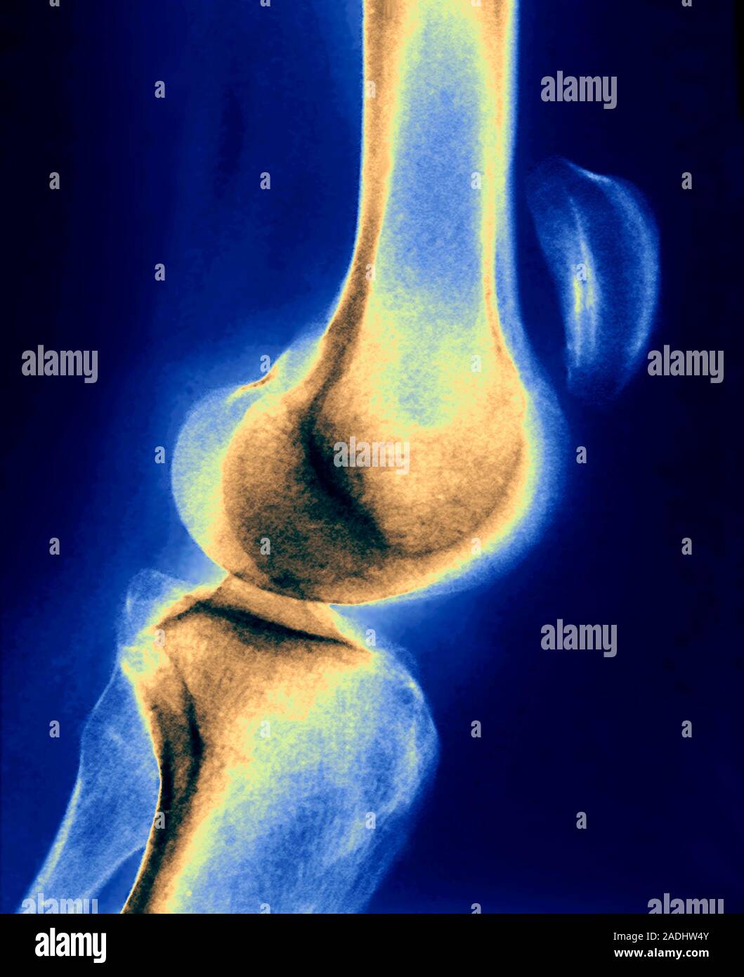 Dislocated kneecap. Coloured X-ray of a side-view of the leg of a ...