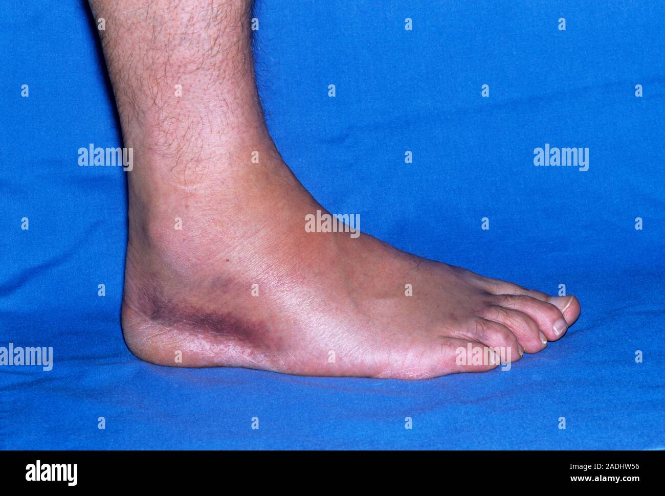 Sprained ankle, day 4. Image 5 of 8. Male patient with a sprained ...