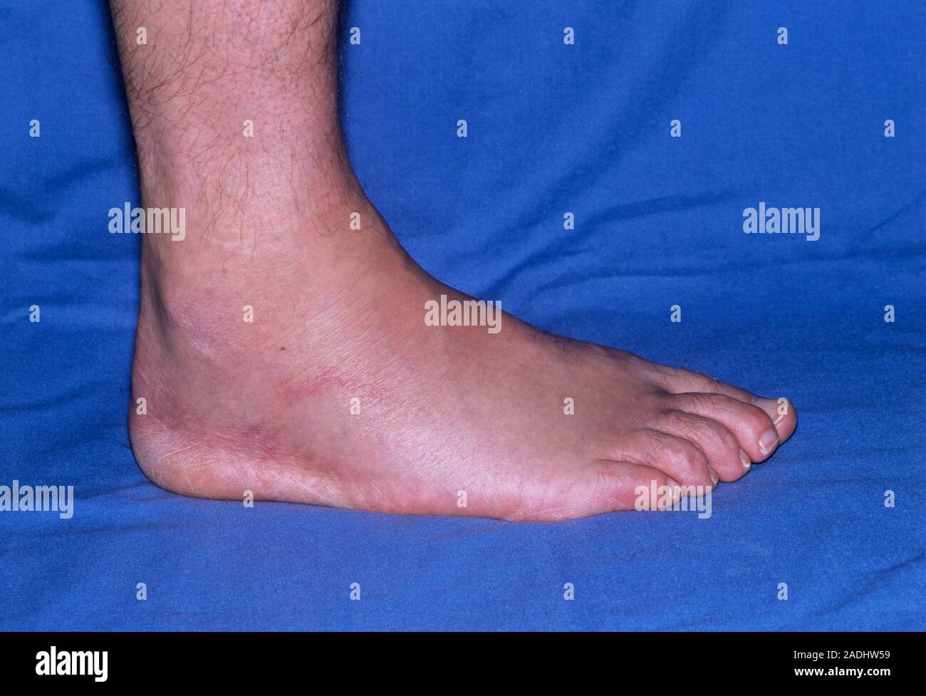 Sprained ankle, day 6. Image 8 of 8. Male patient with a sprained ...