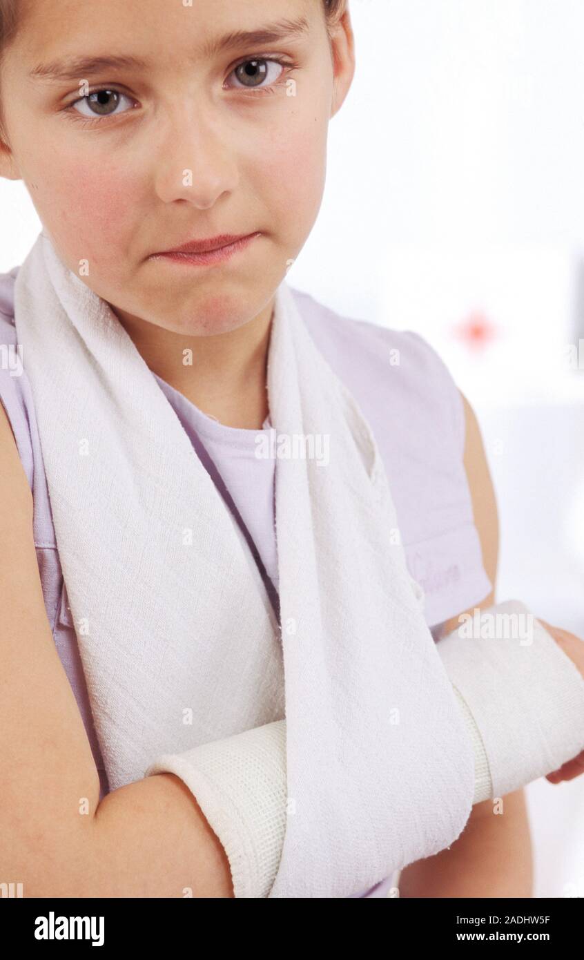 MODEL RELEASED. Broken arm. Young girl with arm in plaster and sling ...
