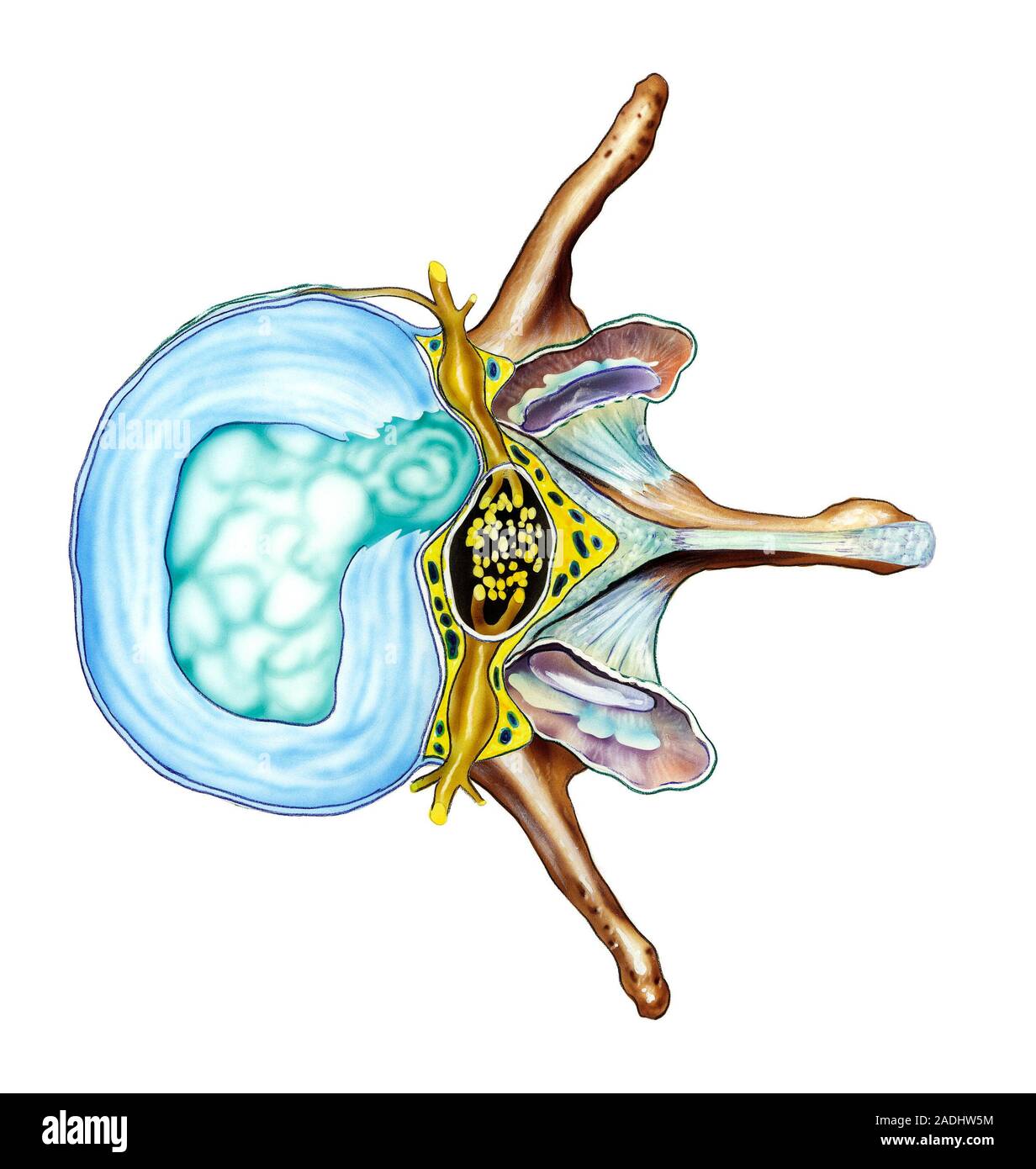 Slipped disc. Artwork of a slipped (herniated) intervertebral disc seen ...