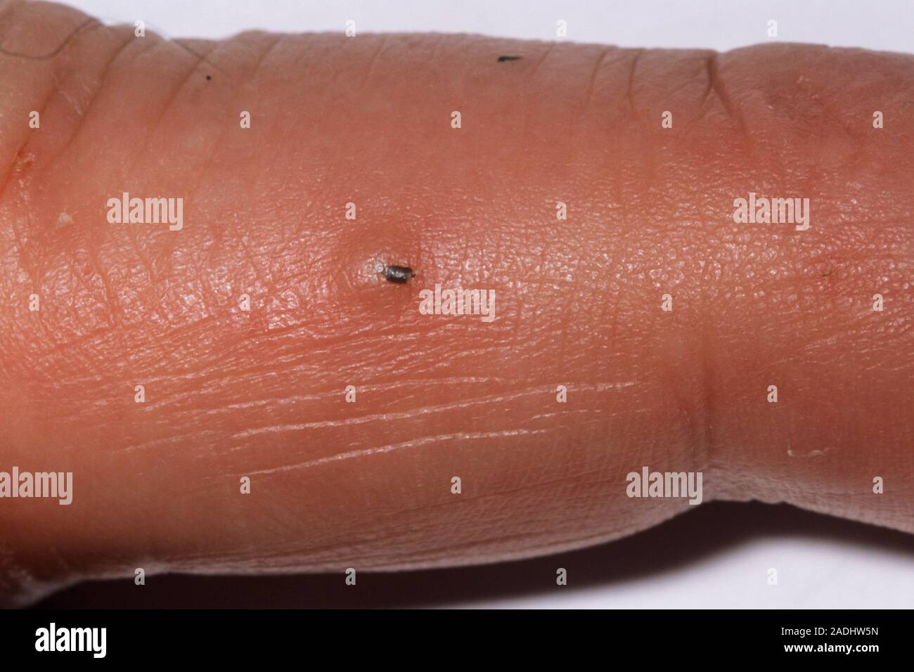 Splinter. Patient with a wood splinter in their finger. The skin around ...