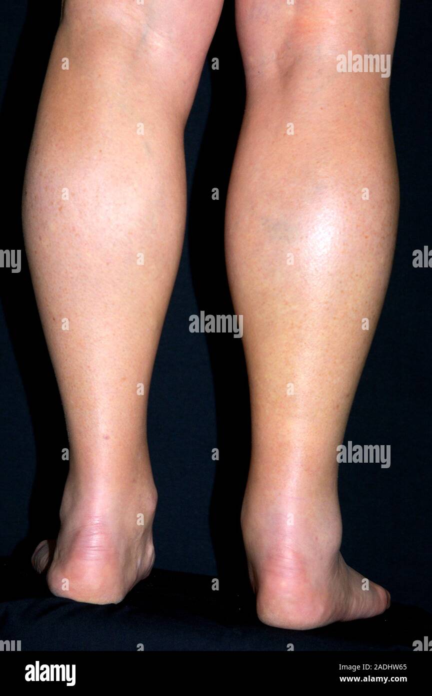 Torn calf muscle. Swollen calf and ankle (right) of a 45-year-old woman ... Torn calf muscle. Swollen calf and ankle (right) of a 45-year-old woman ...