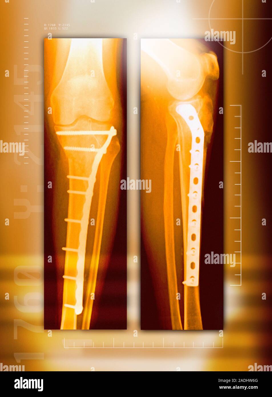 Pinned broken leg. Coloured X-rays of a patient with a pinned broken ...