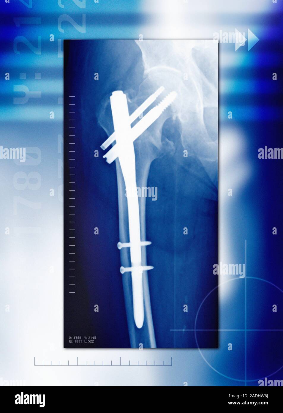 Pinned broken leg. Coloured X-ray of a patient with a pinned broken ...