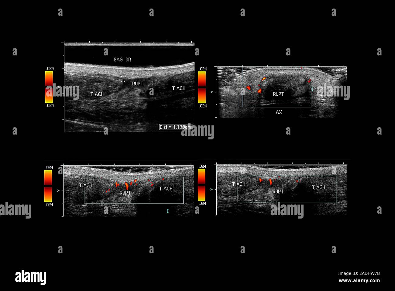 Ruptured Achilles tendon. Coloured doppler ultrasound scans of sagittal ...