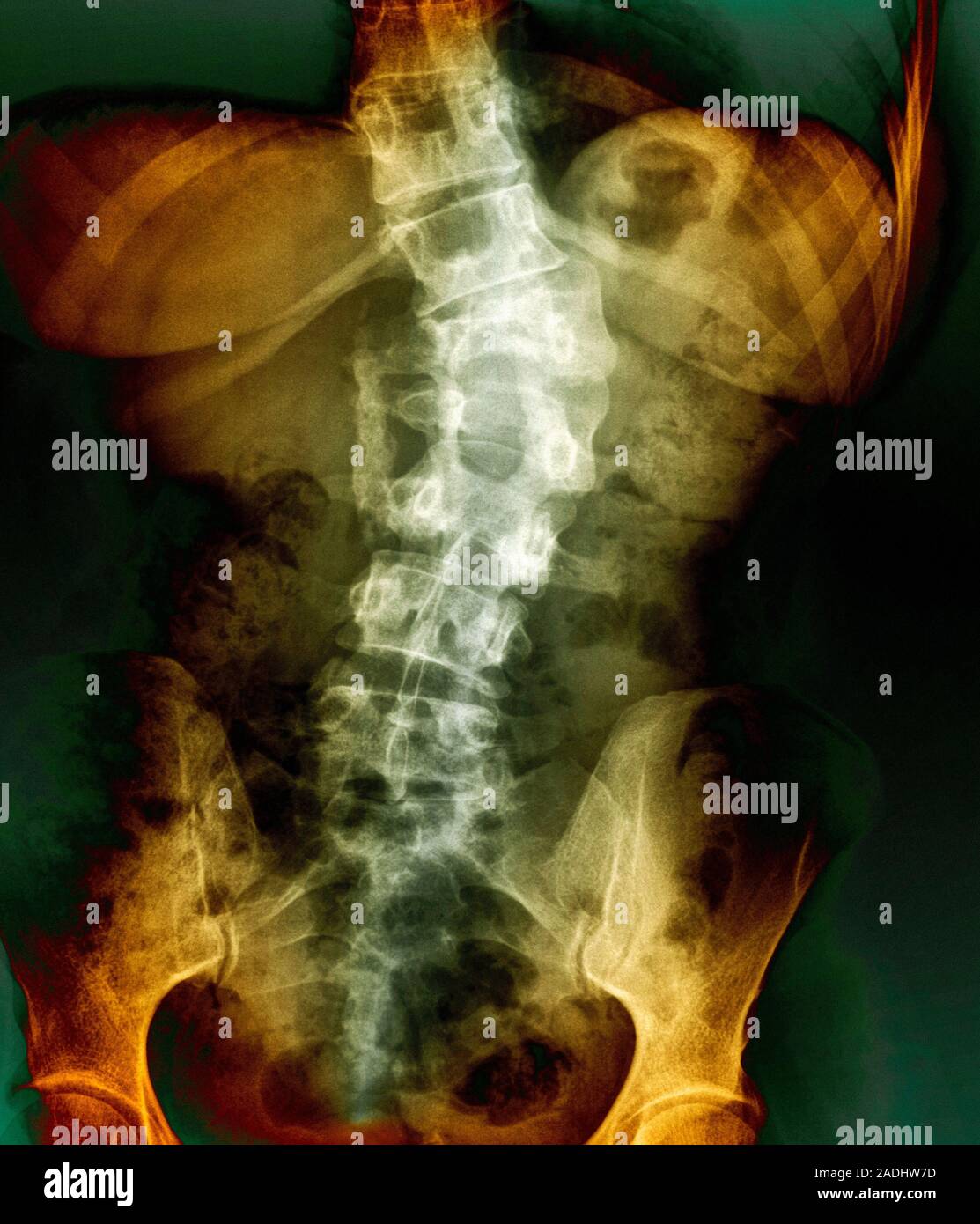 Broken back. Coloured X-ray of the spine of a 28- year-old woman with a ...