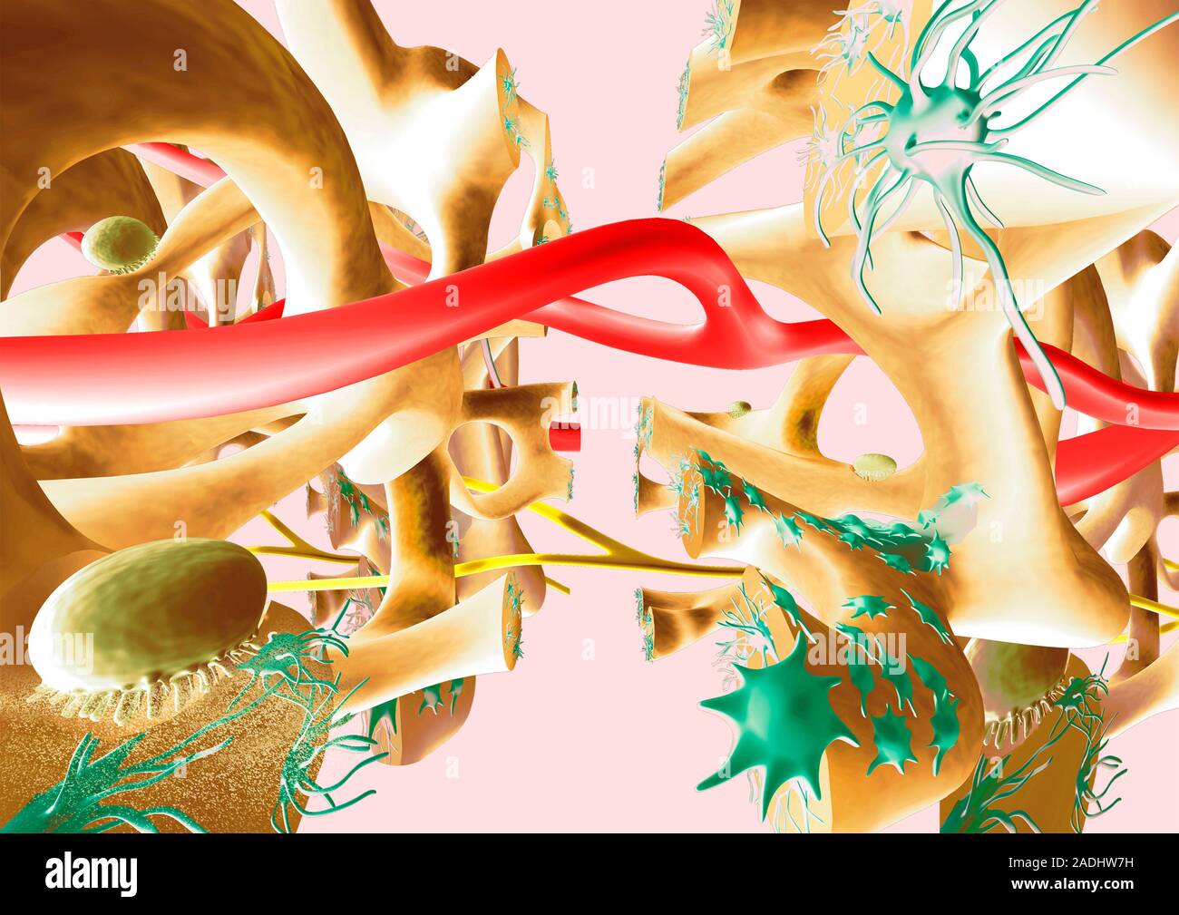 Bone fracture. Computer artwork showing detail of a bone fracture. The ...