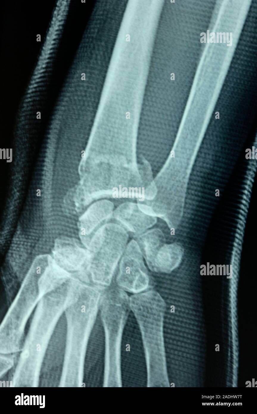 Fractured arm. Coloured X-ray of a broken bone in the forearm of a 56 ...