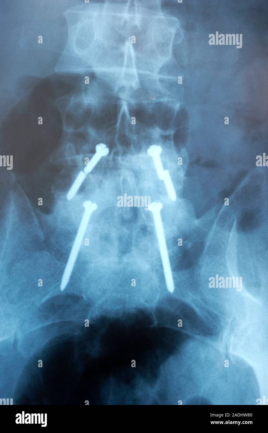 Broken screws. X-ray of broken screws in the lumbar (lower) spine of a ...