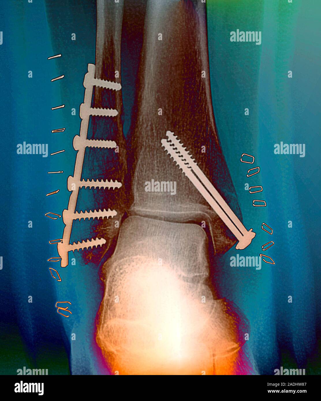 Pinned ankle fracture. Coloured frontal X-ray of the ankle bones of a ...