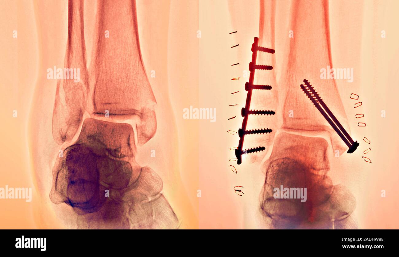 Pinned ankle fracture. Coloured frontal X-rays of the ankle bones of a ...