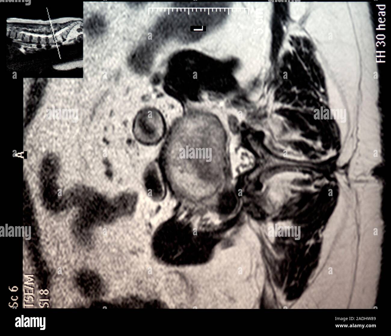 Slipped disc. Magnetic resonance imaging (MRI) scan of the spine of a ...