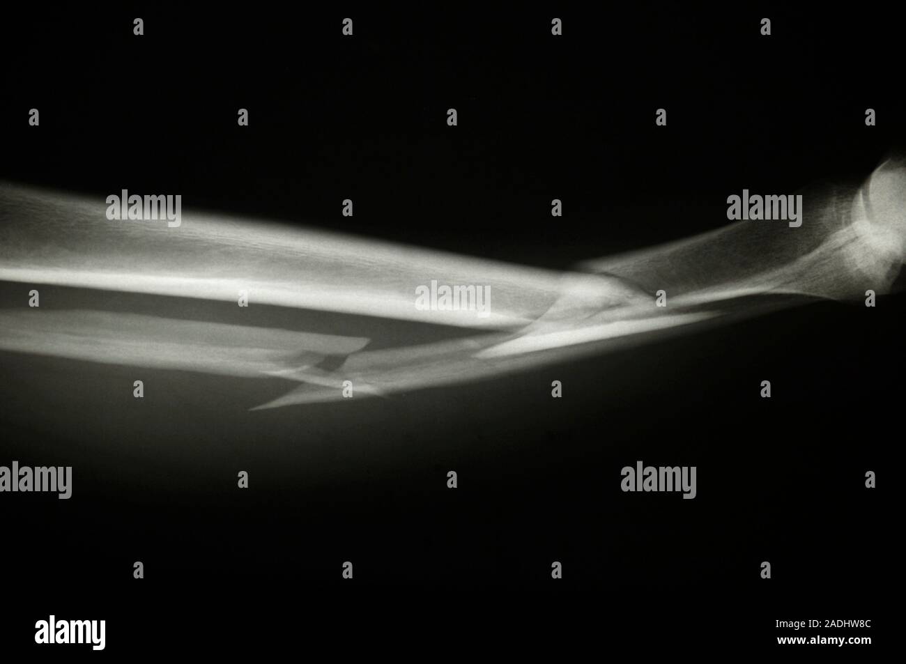 Broken leg. X-ray of the broken leg of a 60 year old woman after a fall ...