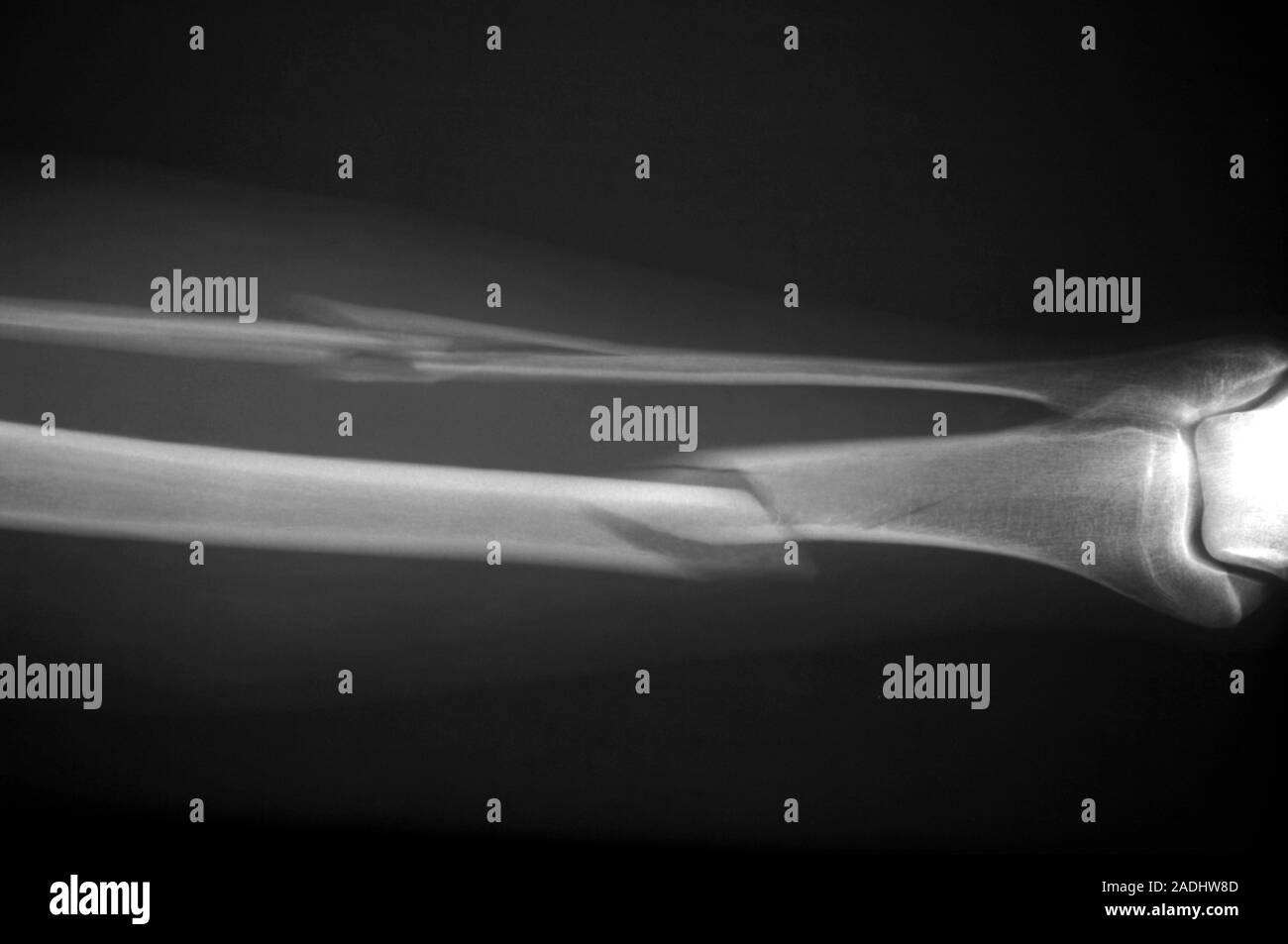 Broken leg. X-ray of the broken leg of a 60 year old woman after a fall ...
