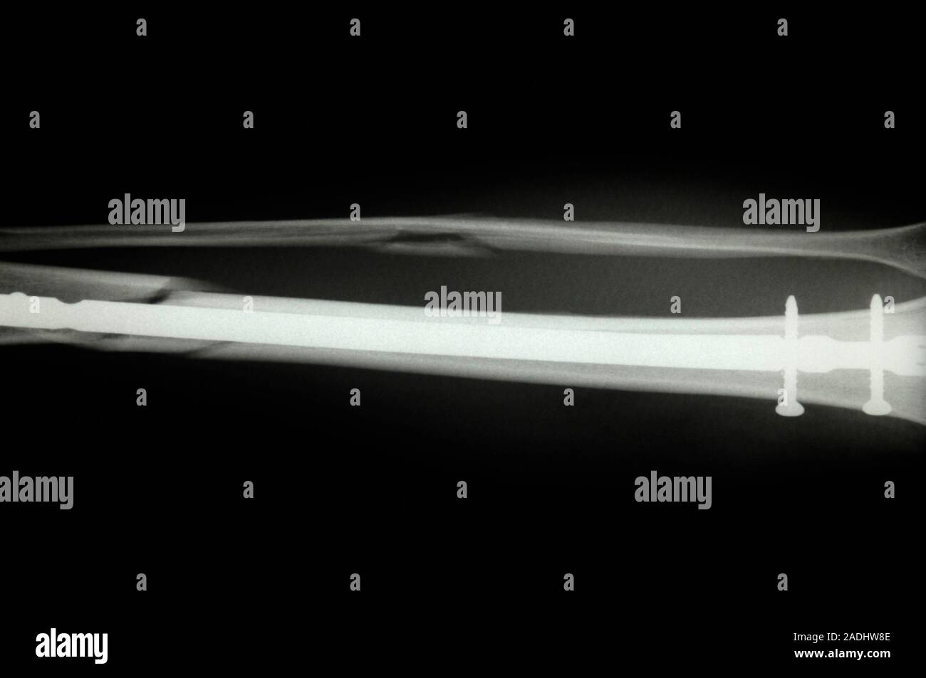 Pinned broken leg. X-ray of a 60 year old woman's pinned broken leg ...