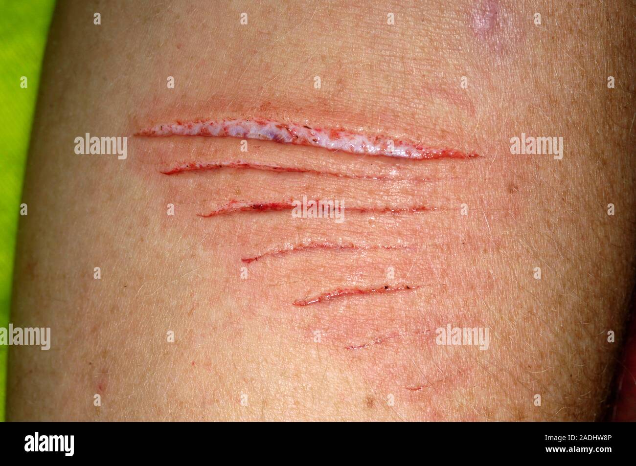 Cut arm. Cuts on a 35 year old man's forearm caused by an accident with a saw Stock Photo - Alamy