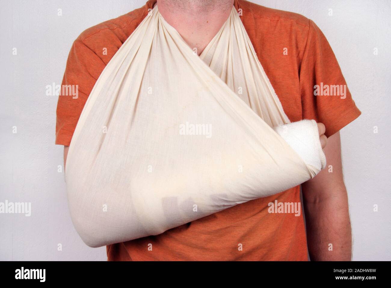 MODEL RELEASED. Broken hand. 38 year old man with his broken hand in a ...