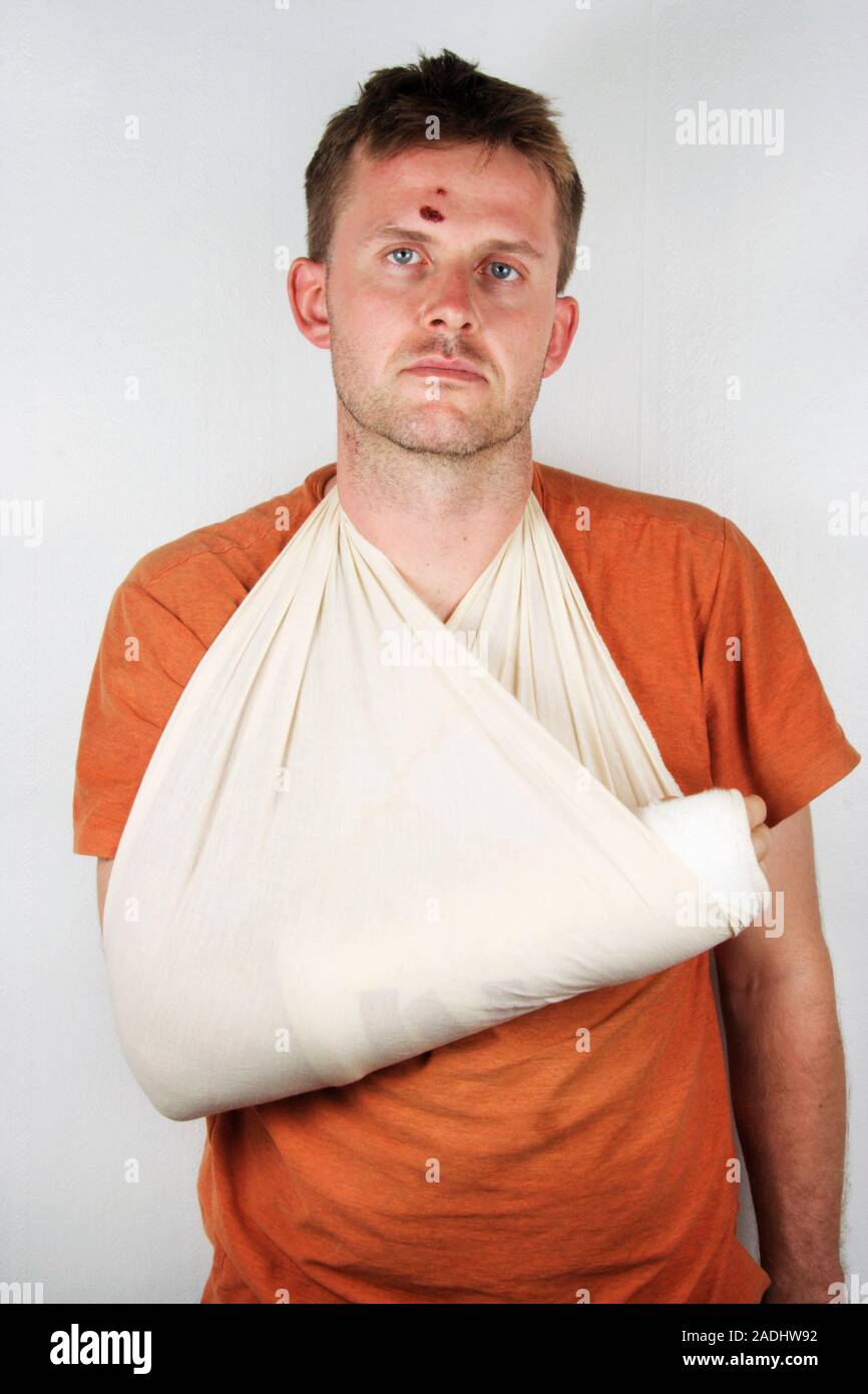 MODEL RELEASED. Broken hand. 38 year old man with his broken hand in a ...
