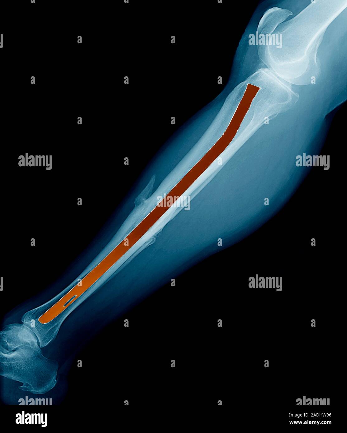 Pinned broken leg, coloured X-ray. The patient's tibia (shin bone) has ...