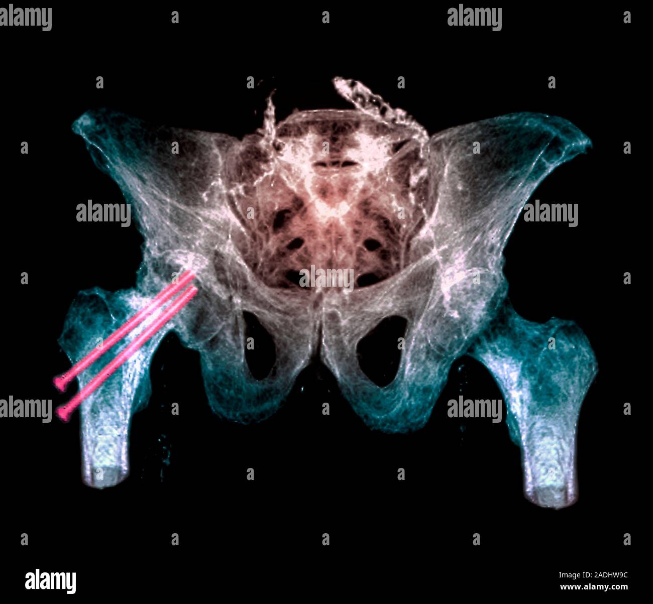 Pinned broken hip, coloured X-ray. The head of the patient's femur ...