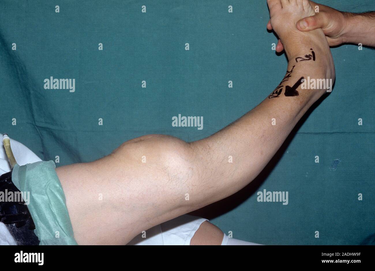 Knee joint laxity. Doctor manipulating a patient's knee before a total ...