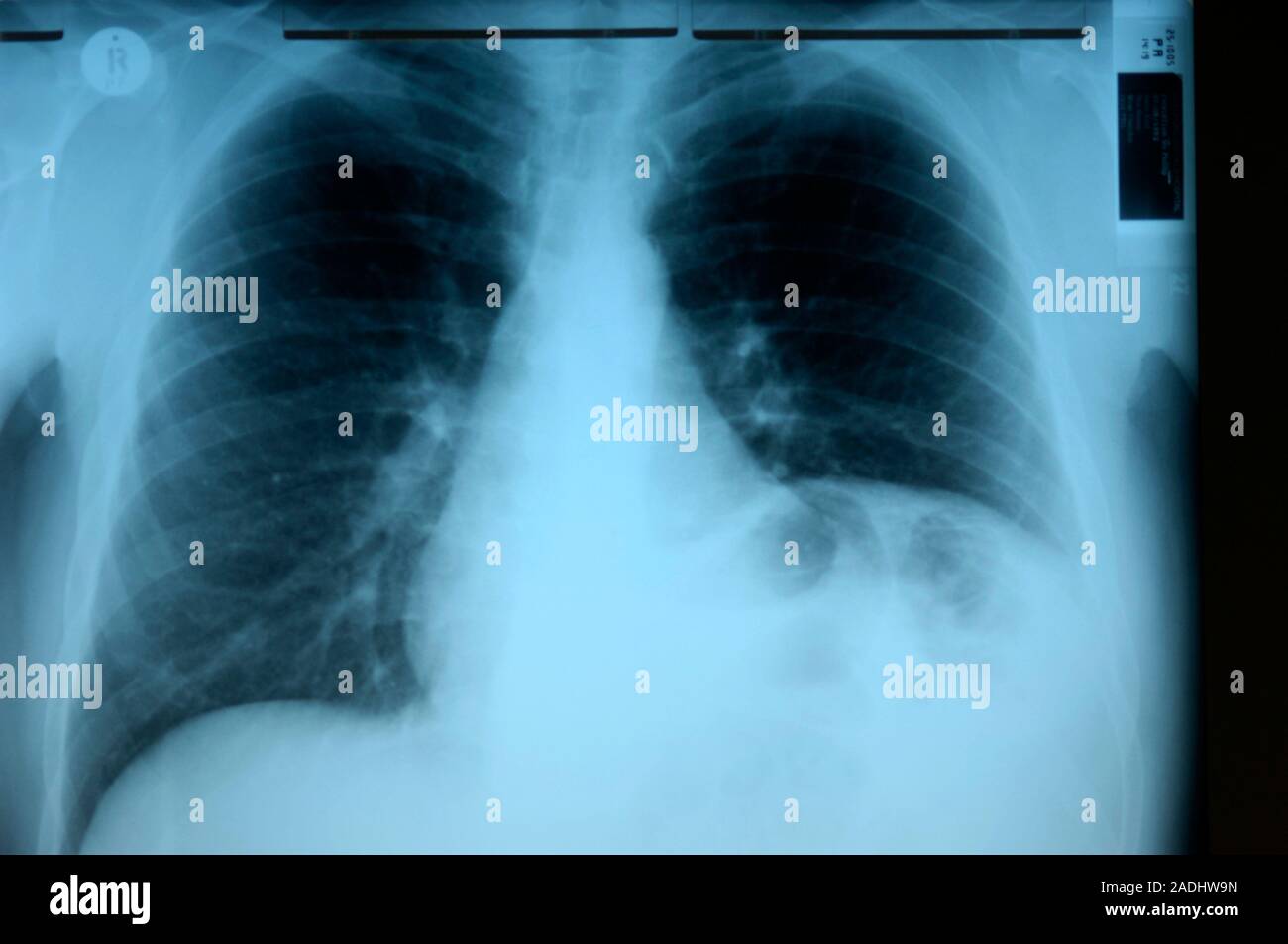 Raised hemidiaphragm. Chest X-ray showing raising of the diaphragm ...