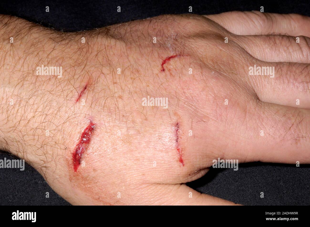 Dog bite marks on a 55-year-old man's hand. Animal bites can lead to ...