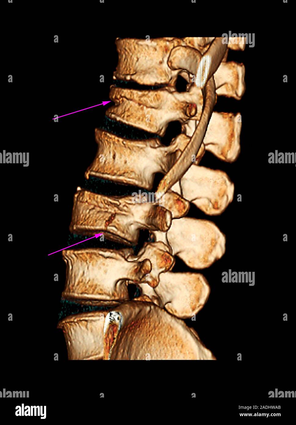 Fractured spine. Coloured 3D computed tomography (CT) scan showing a ...