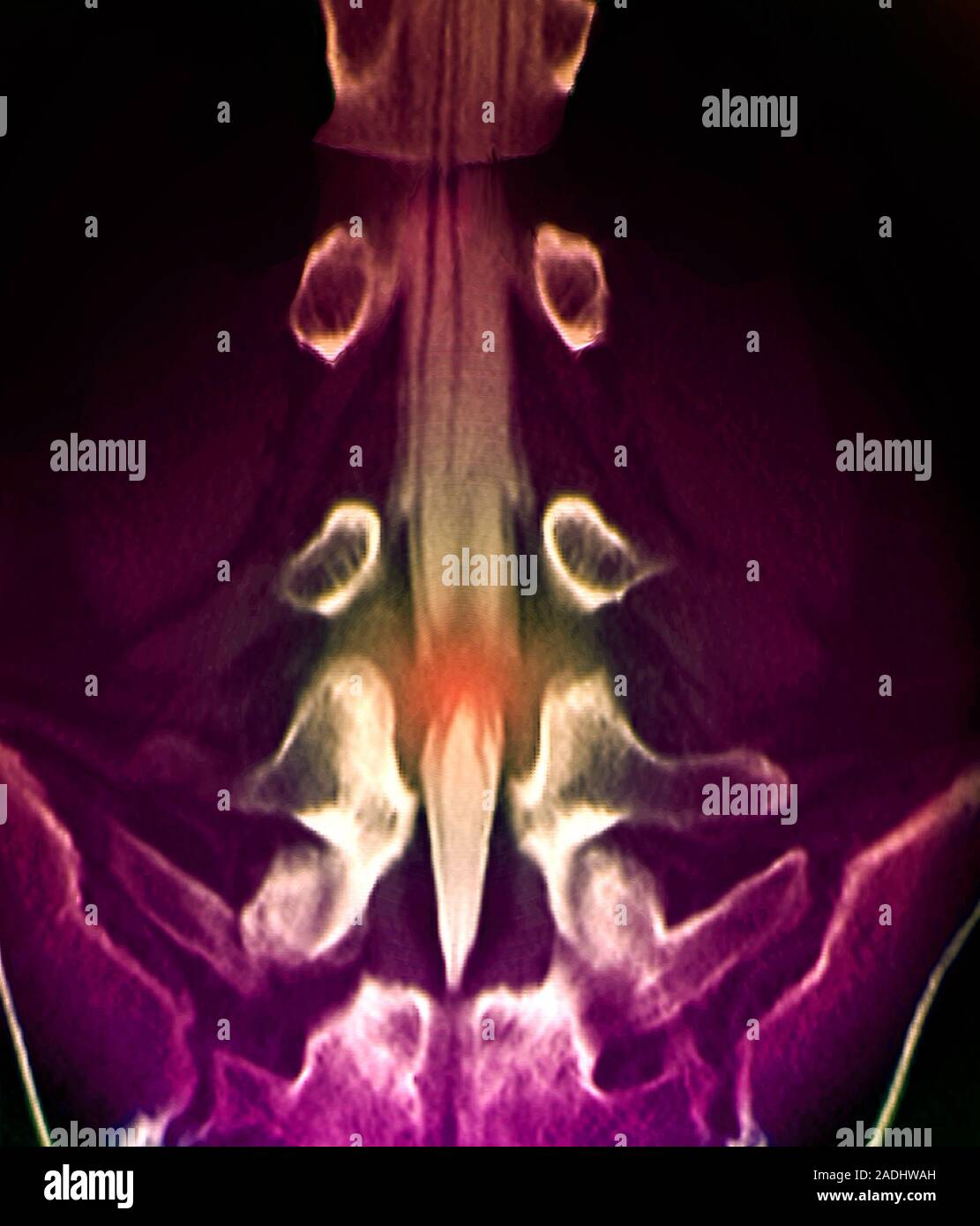 Slipped disc. Coloured frontal computed tomography (CT) scan of the ...
