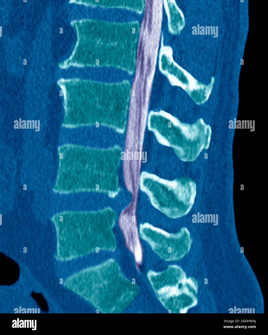 Slipped disc. Coloured profile computed tomography (CT) scan of the ...