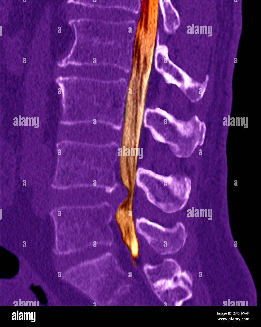 Slipped disc. Coloured profile computed tomography (CT) scan of the ...