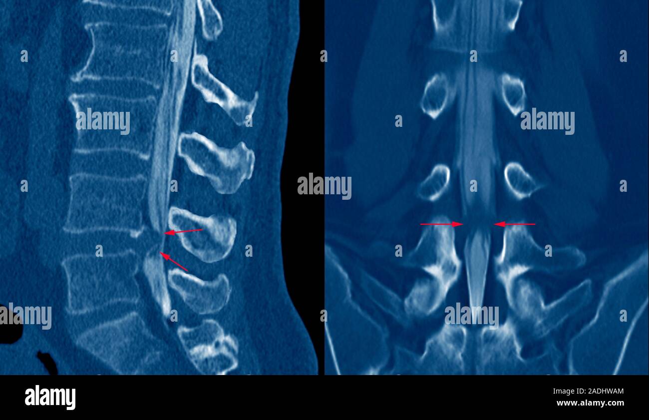 Slipped disc. Coloured profile (left) and frontal (right) computed ...