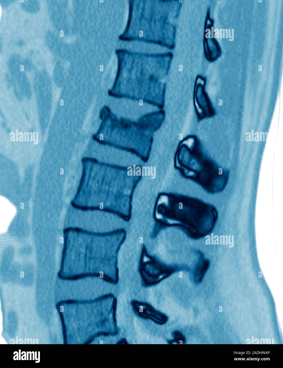 Fractured spine. Coloured profile computed tomography (CT) scan of the ...