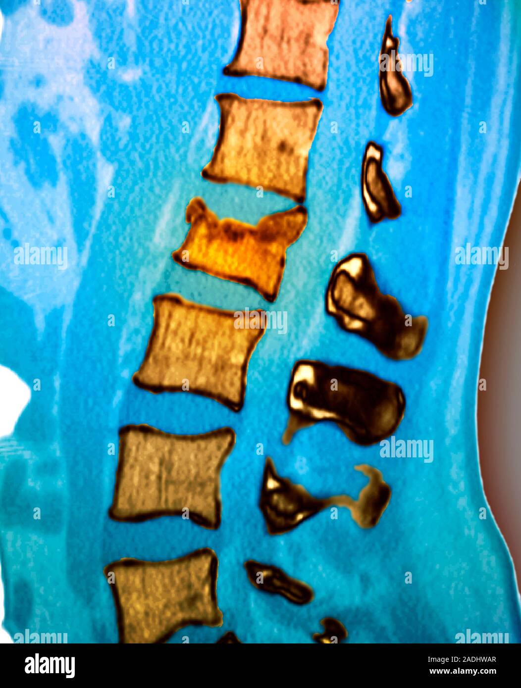 Fractured spine. Coloured profile computed tomography (CT) scan of the ...