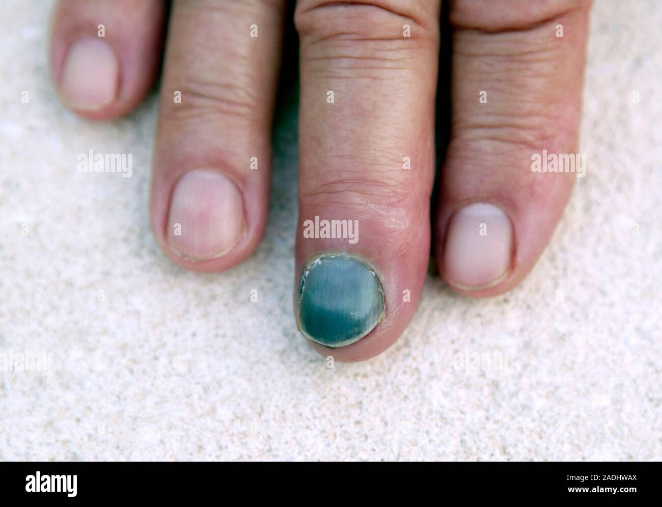 Bruised fingernail. Blood under a patient's fingernail, caused by an ...