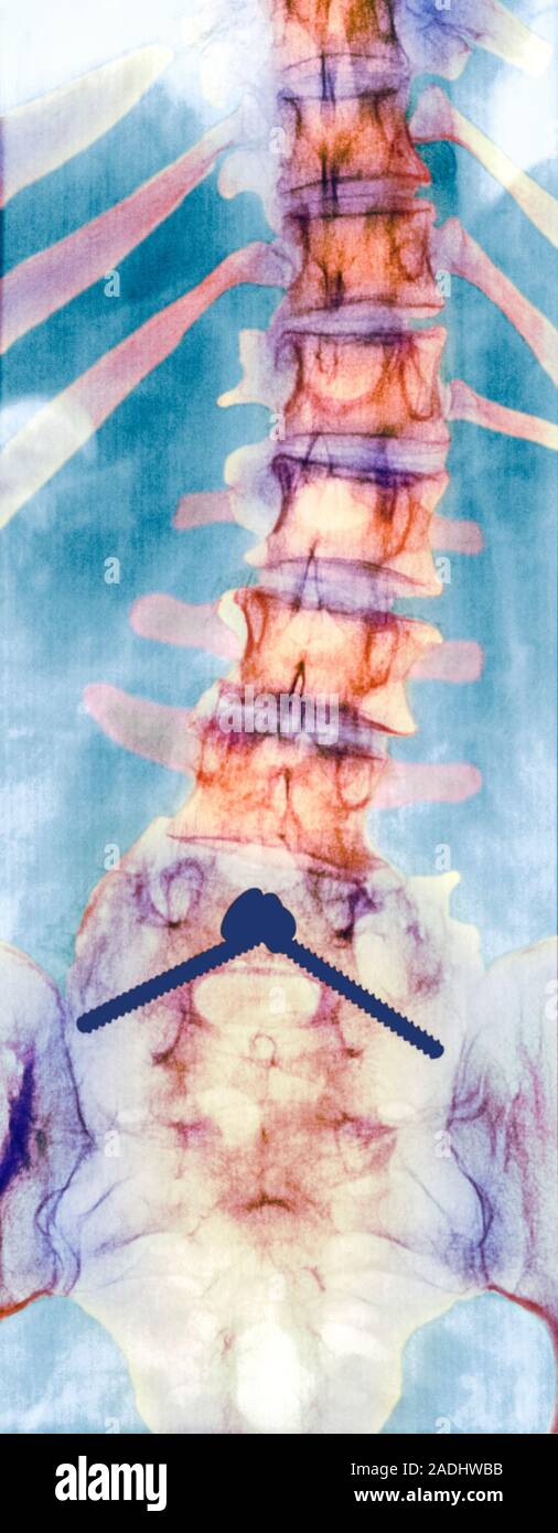 Pinned curved spine. Coloured X-ray of bones of the spine and pelvis of ...