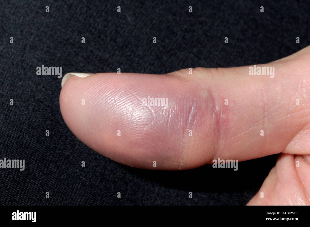Fractured thumb. Bruised and swollen thumb of a 56 year old woman. The ...