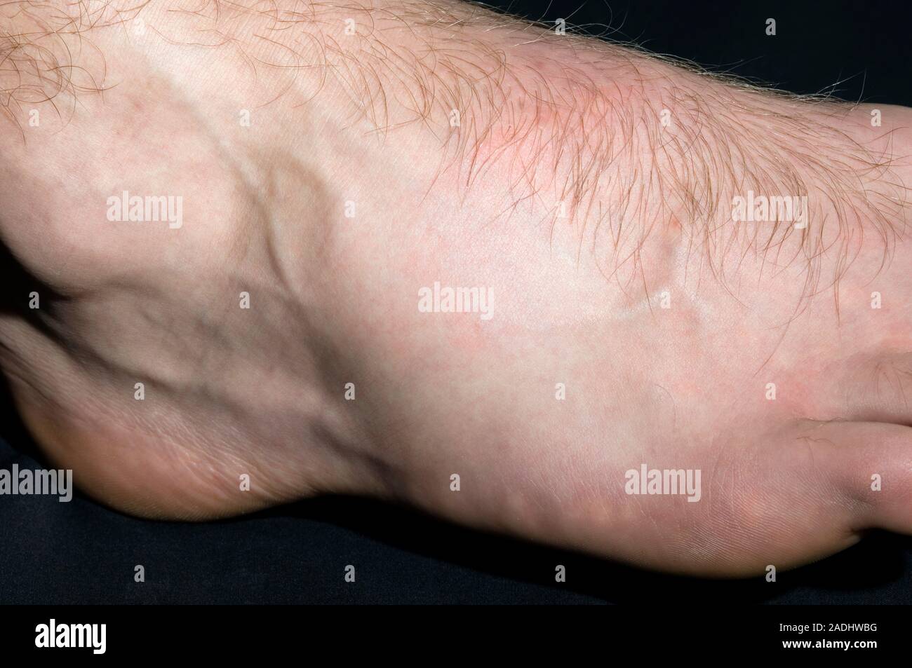 Swollen foot of a 17 year old boy due to a football injury. This is a ...