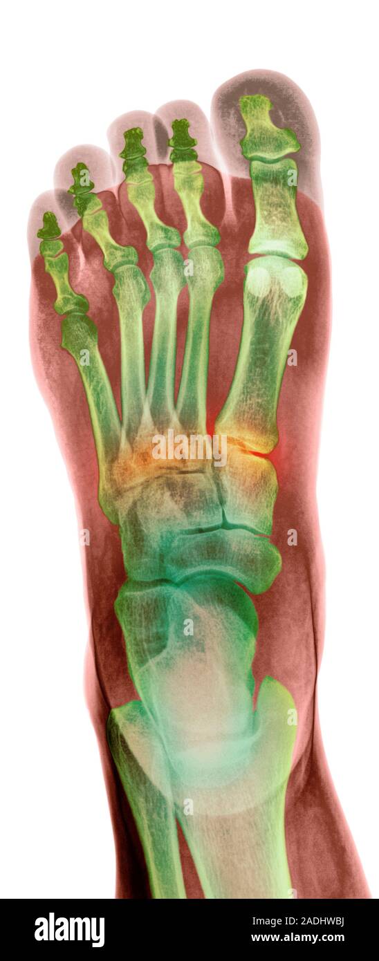 Crushed broken foot. Coloured X-ray of the foot of an adult woman ...
